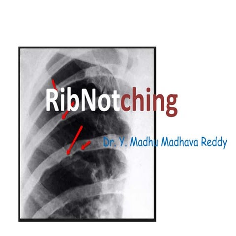 Rib notching | PPTX | Bone and Joint Conditions | Diseases and Conditions