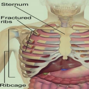Rib Fractures, Flail Chest & Stove In Chest | PPTX