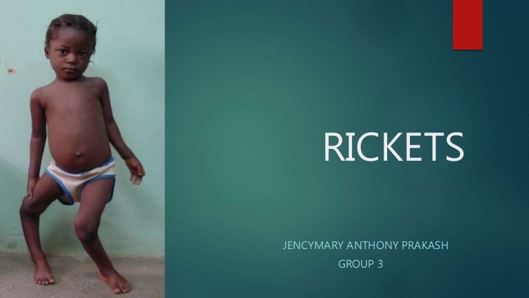 Rickets