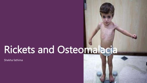 RICKETS : introduction, clinical features, Diagnosis, PT mangement | PPT