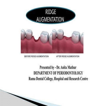 RIDGE AUGMENTATION - Rationale, Techniques.pptx