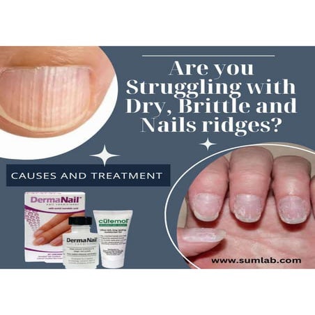 What deficiency causes ridges in fingernails? | PDF