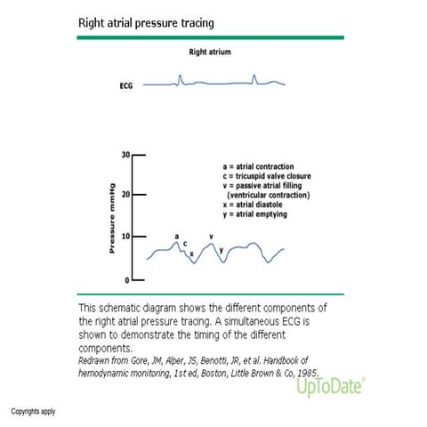 Right atrial pressure tracing | PPT