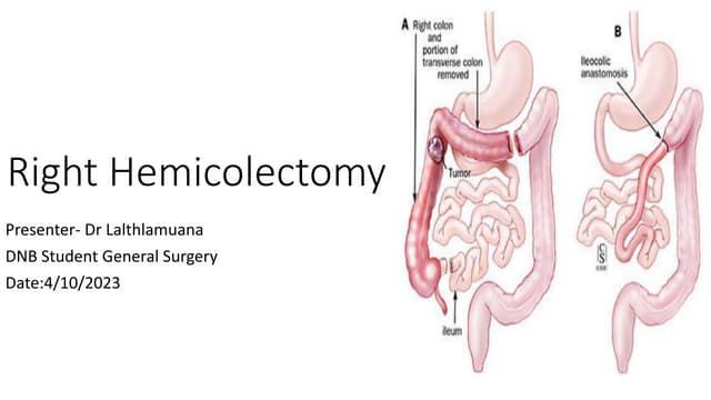 LAP RIGHT HEMICOLECTOMY-STEP BY STEP Operative Surgery.pptx