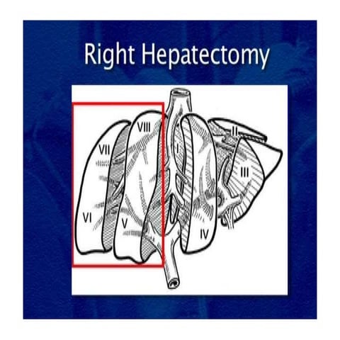 Right hepatectomy - step by step description for surgeon. | PPTX