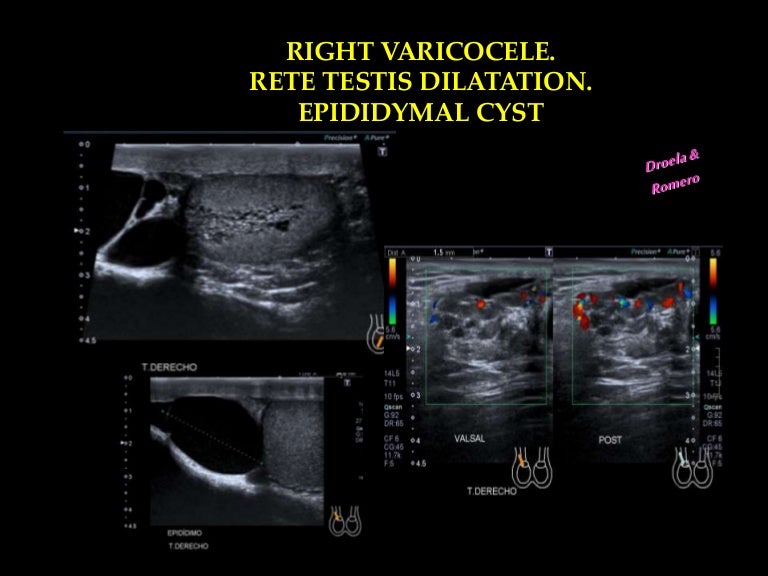Varicocele Grading