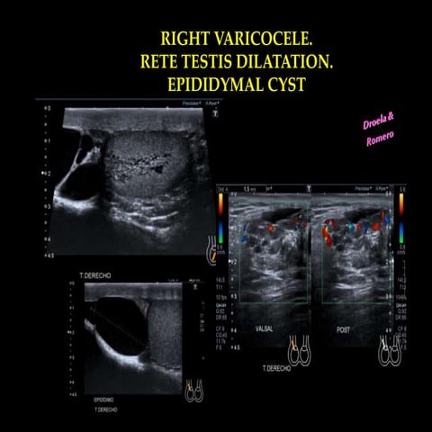 Right varicocele. Ultrasound. | PPT