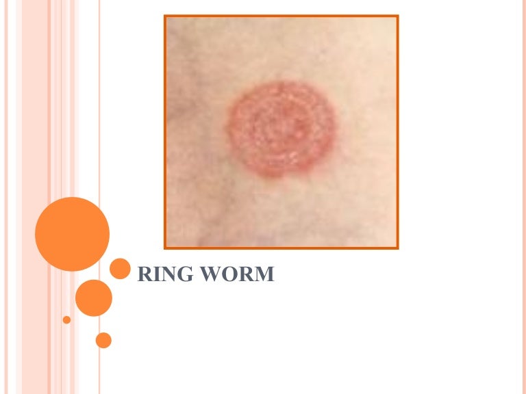 Ring Worm