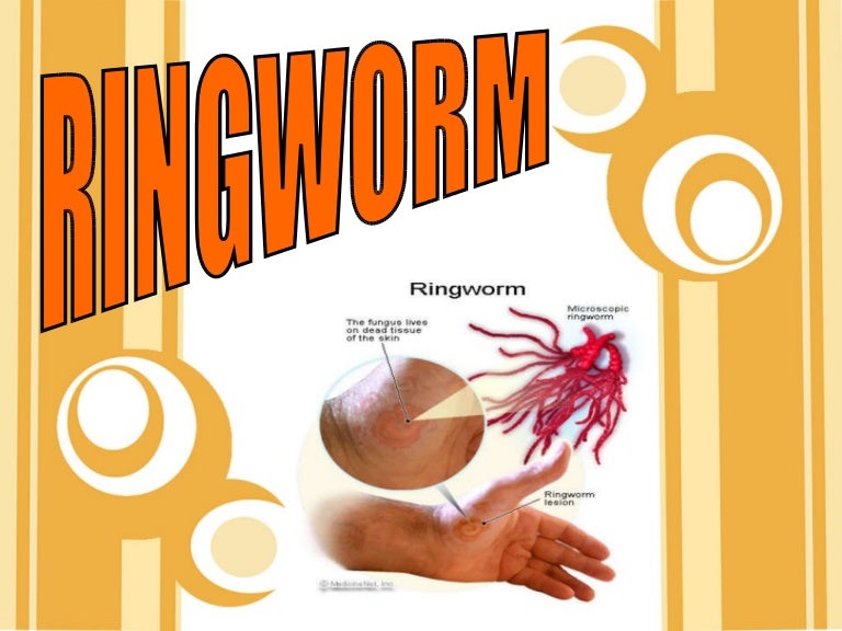 Ringworm
