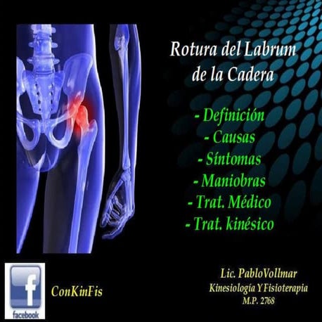Rotura del Labrum de la Cadera | PDF