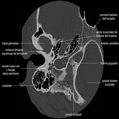 Anatomia Rocca TC - CT temporal bone anatomy | PPT | Ear, Nose and ...