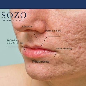 Rolling Scars: What is it and Their Treatments? | PPT