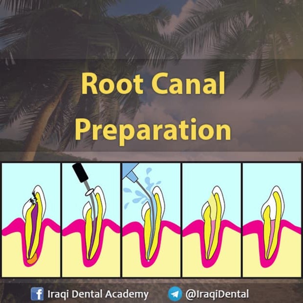 Root Canal Preparation Simplified | PPT