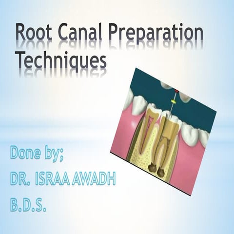 Root canal preparation techniques _ endodontic treatment | PPTX