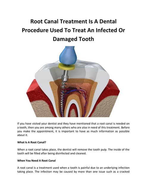 Things to Avoid During a Root Canal Treatment | PPT