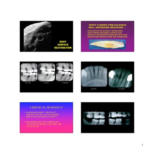 Root caries restoration.07.ppt