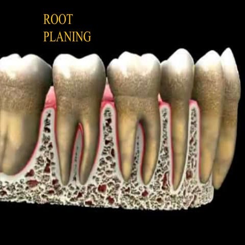 Root planing | PPTX
