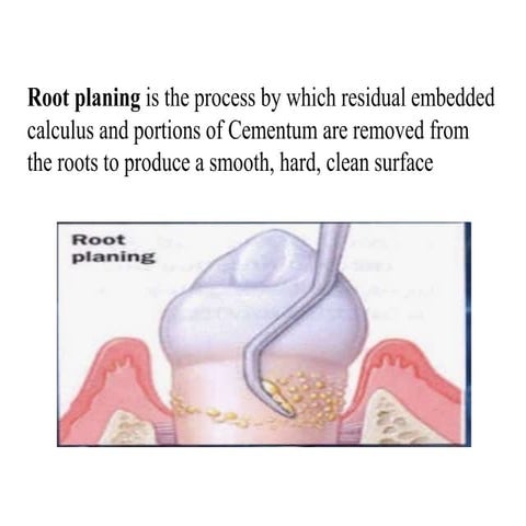 root planing.pptx | Dental Health | Diseases and Conditions