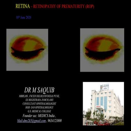 RETINOPATHY OF PREMATURITY | PPT