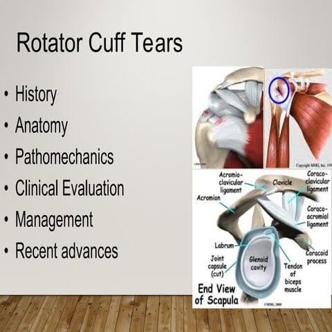 -ROTATOR CUFF TEARS BRIEF PRESENTATION . | PPT