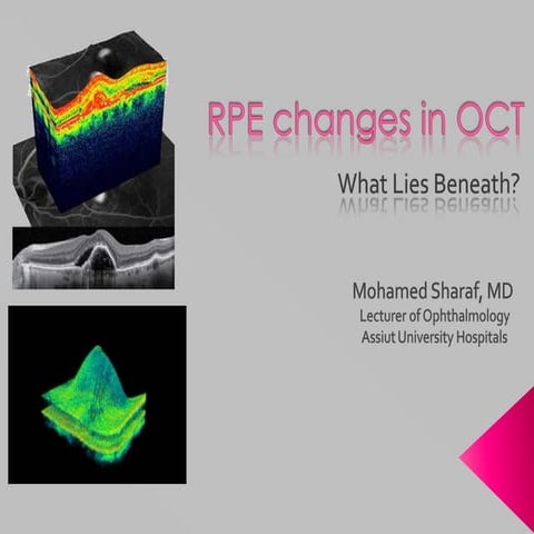 RPE changes in OCT | PPTX