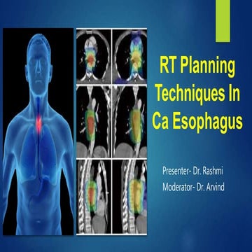 RT in Ca esophagus | PPTX