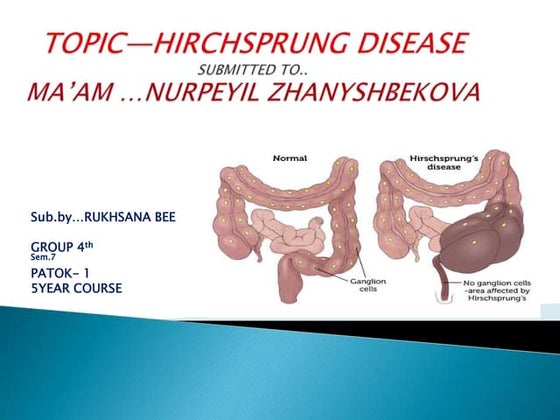 Hirschsprung's disease | PPTX
