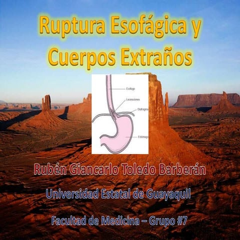 Ruptura esofagica y cuerpos extraños | PPTX
