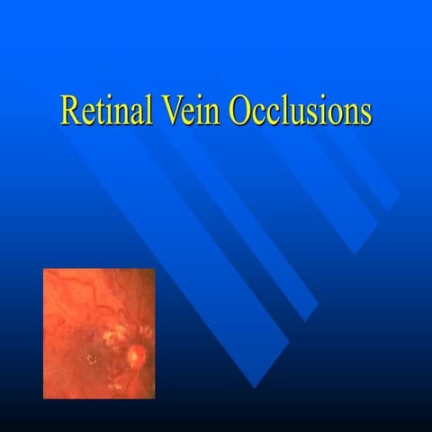 rvo.ppt retinal vein occlusion reti00nal | PPT