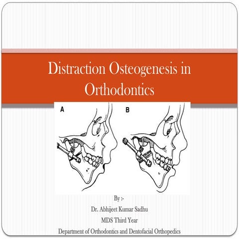 distraction osteogenesis in orthodontics | PPTX