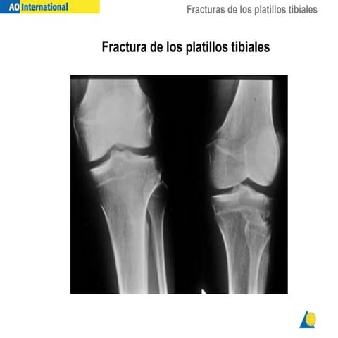 Fracturas del platillo tibial | PDF
