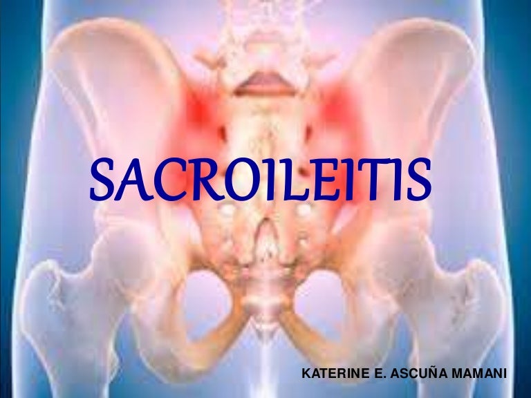 Sacroileitis