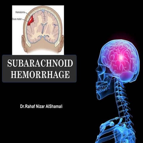 Subarachnoid hemorrhage | PPT