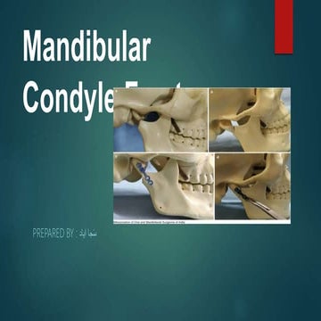 Condylar fracture | PPTX