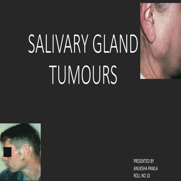 SALIVARY GLAND TUMOURS | PPTX