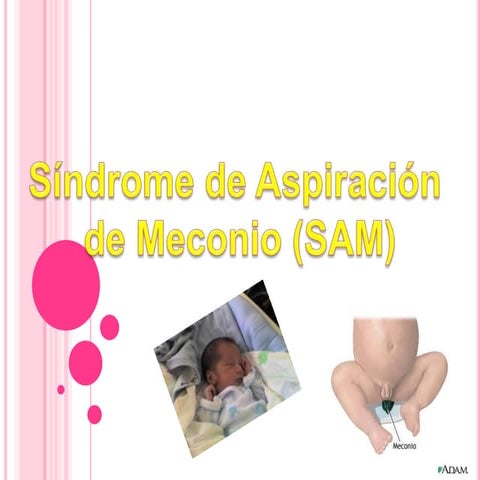 sindrome de aspiracion de meconio expoppt | PPT