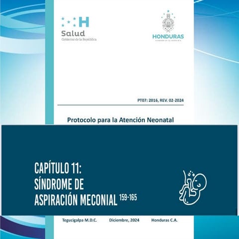 sindrome de aspiracion de meconio en neonatos | PPTX