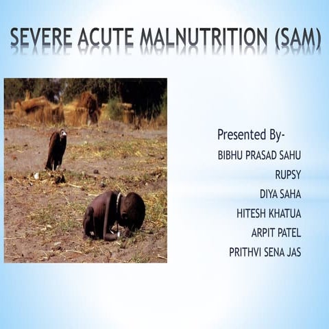 Severe Acute Malnutrition | PPTX