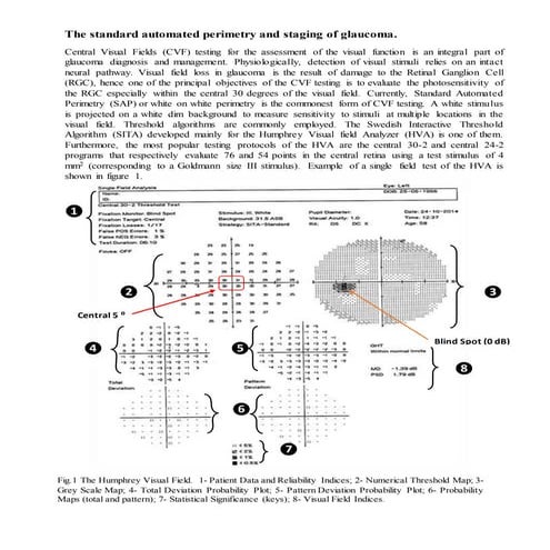 The standard Automated Perimetry and staging of Glaucoma | PDF
