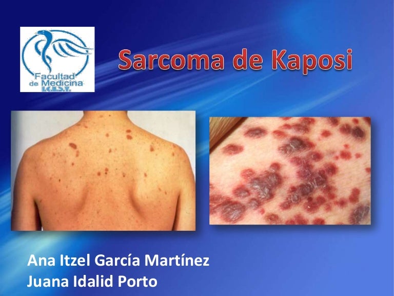 Sarcoma de kaposi