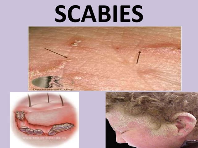 Anatomy & Physiology Integumentary System Disorder, Scabies