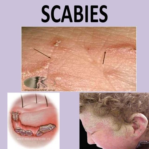 Scabies | PPTX