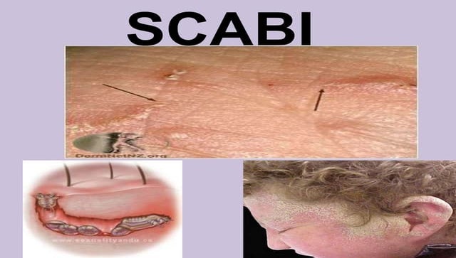 Early Scabies Rash