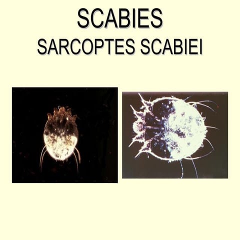 Scabies ppt | PPT