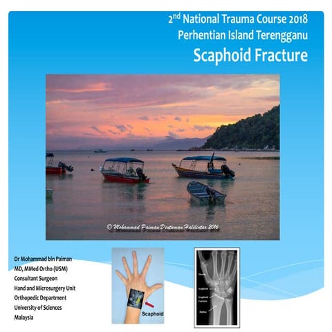 Scaphoid Fracture-RS.wjebndvuieboviewpdf | PDF