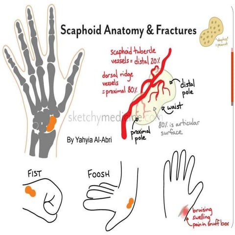 Arthroscopic treatment of scaphoid fractures & nonunions