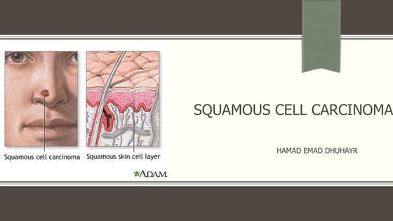 Squamous cell carcinoma of skin | management -all medical aspects. | PPT