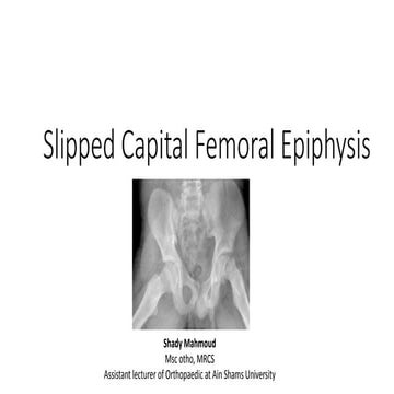 Slipped Capital Femoral Epiphysis | PPTX