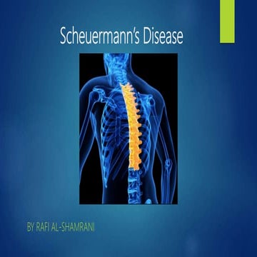 Scheuermann's disease | PPTX