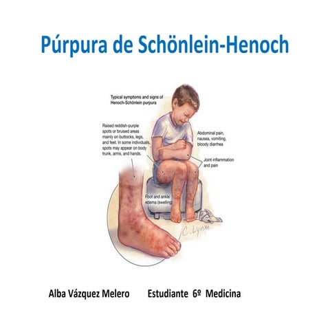 Schonlein henoch | PPT